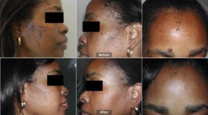 DPN Removal NYC | Dermatologist in Brooklyn, NY