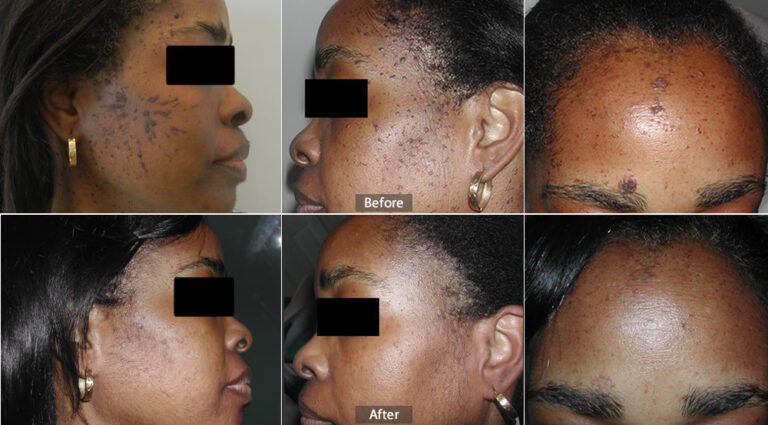 DPN Removal NYC | Dermatologist in Brooklyn, NY