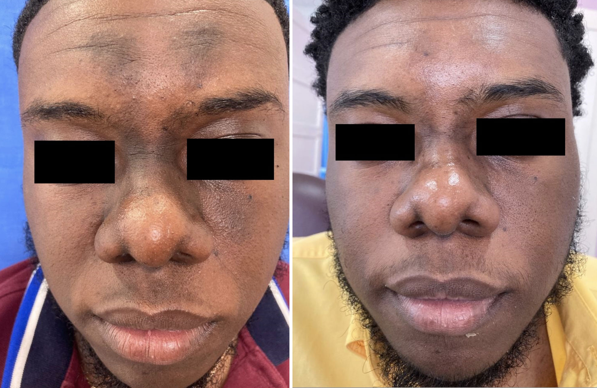 Hyperpigmentation | Brooklyn Dermatology Clinic