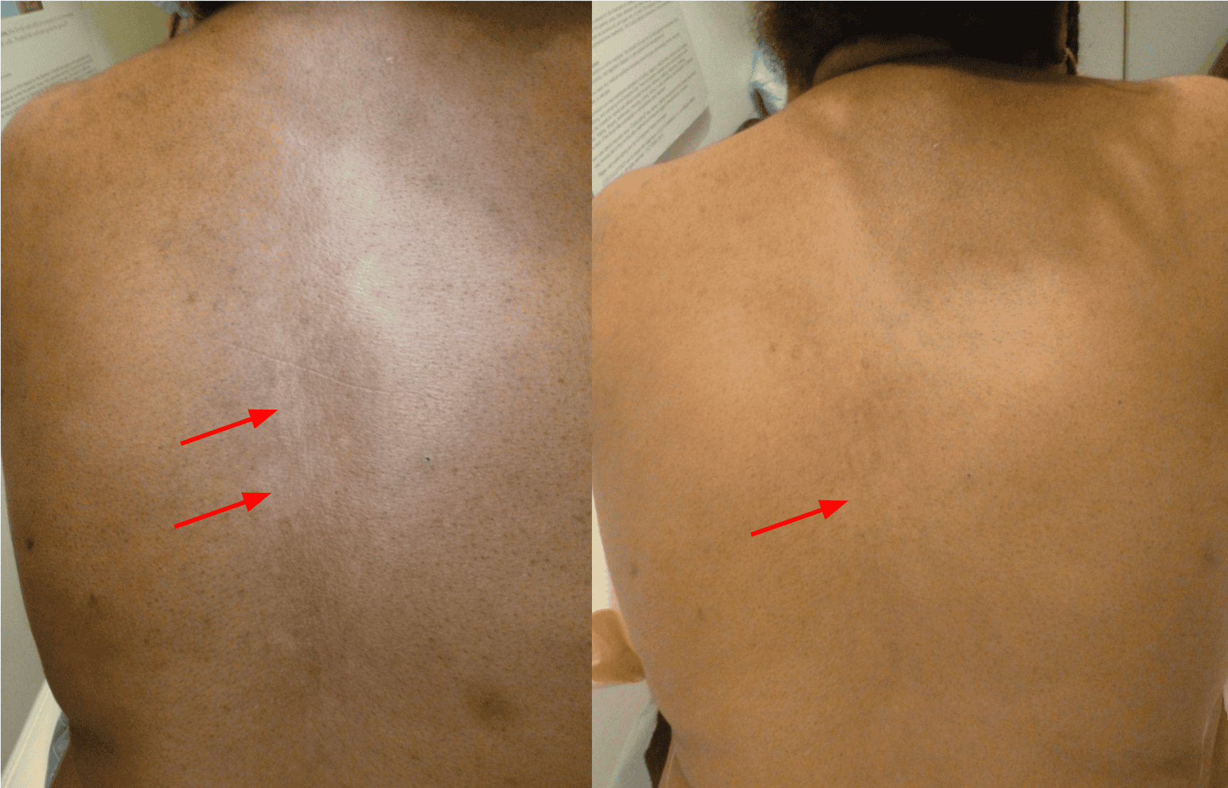 Spotty Back | Brooklyn Dermatologist