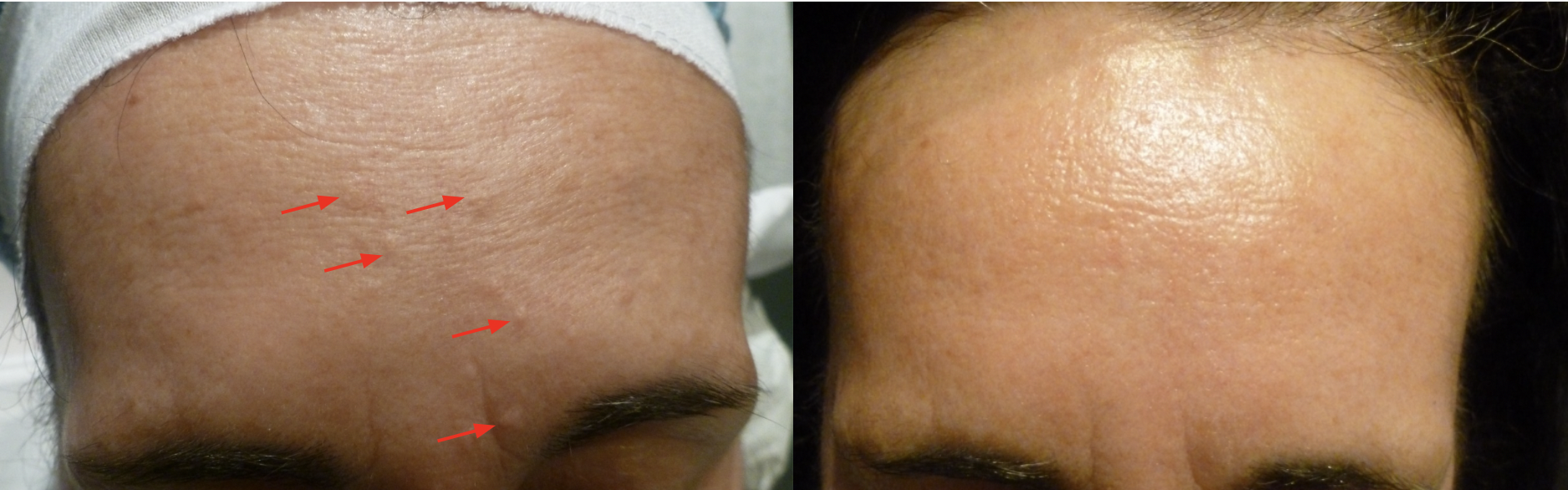 Bumps on Skin | Brooklyn Dermatology Clinic